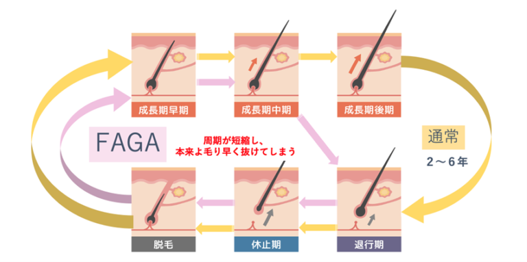 女性の薄毛（FAGA）治療 - makiスキンケアクリニック - 八王子の美容皮膚科